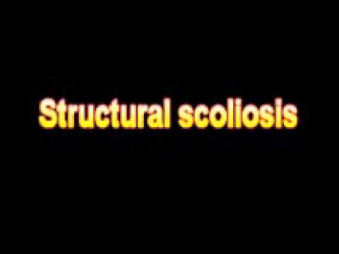 What Is The Definition Of Structural scoliosis Medical School Terminology Dictionary