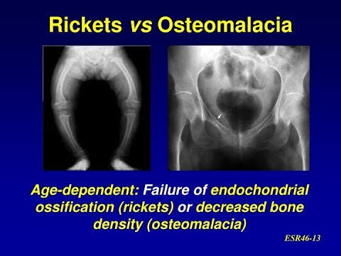 Discussion on Rickets and Osteomalacia ; Definition, Differences, Features, Similarities
