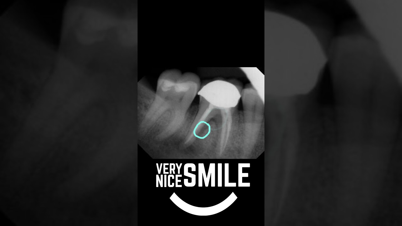 Failing Root canal x-ray