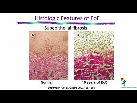 Eosinophilic Esophagitis: Don’t Miss It! - Dr. D Atkins