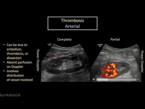 Kidney transplant: imaging overview