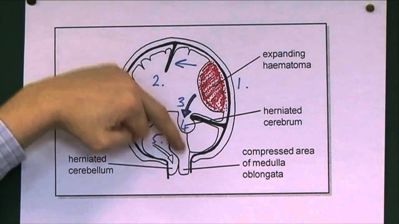Tentorial herniation