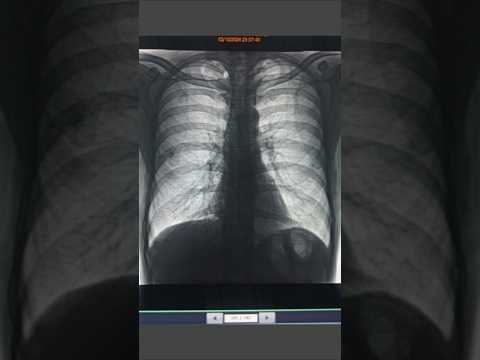 Xray Chest ap exam #anatomy #xraytechnician #humanbodyjoint