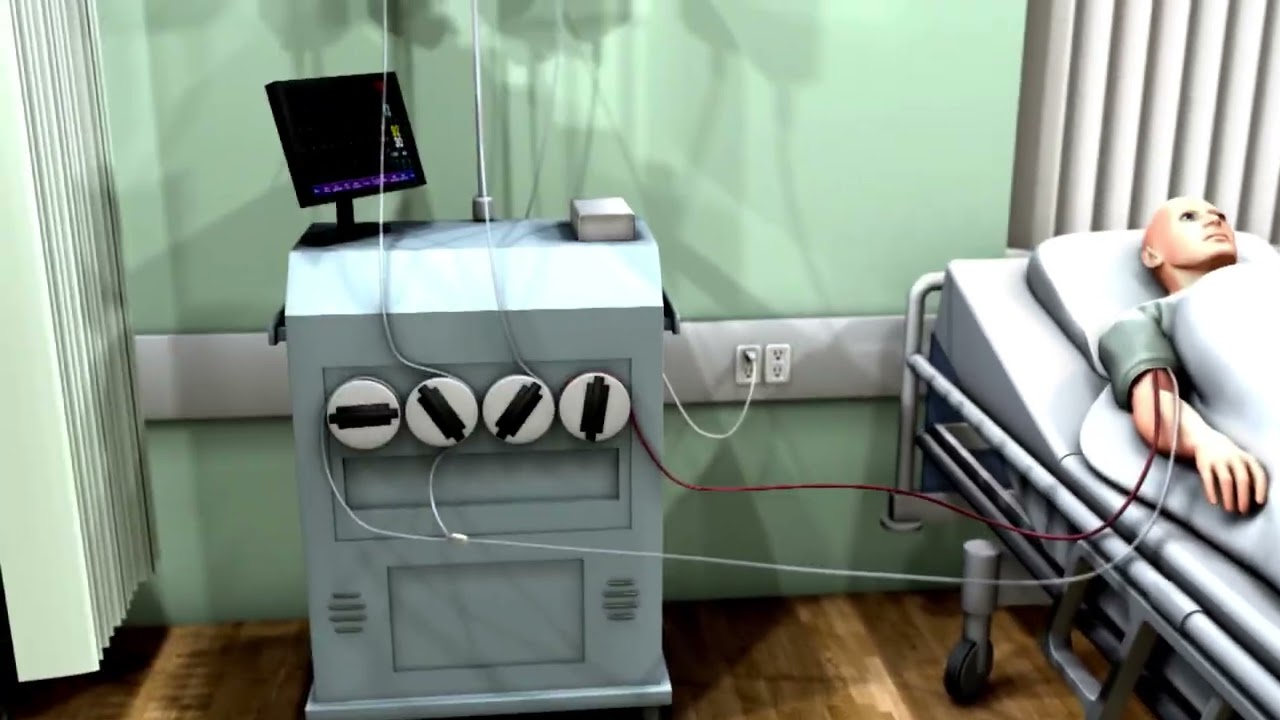 What is Plasmapheresis (Therapeutic Plasma Exchange)?