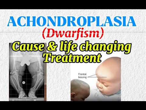 Achondroplasia (Dwarfism) | Cause, prevention & life changing treatment