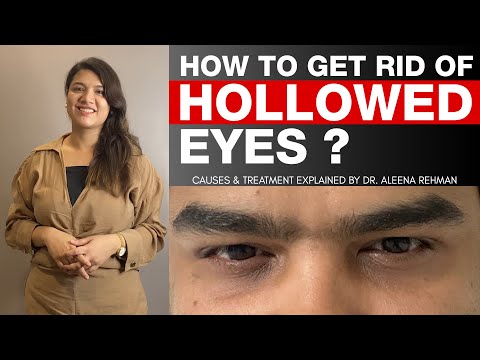 What causes hollowed eyes? What are the treatment options for hollowed eyes?