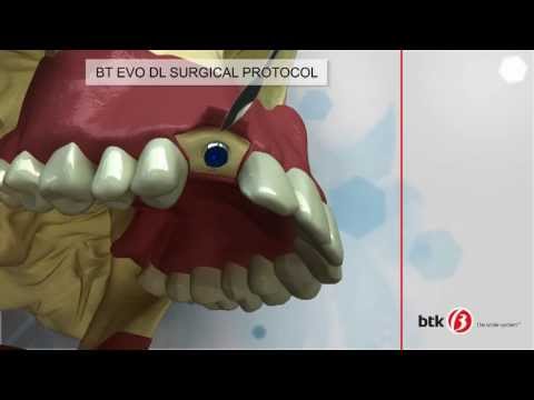 BTK The Smile System - Surgical protocol BT EVO