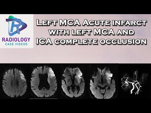 Left MCA Acute infarct with left MCA and ICA complete occlusion