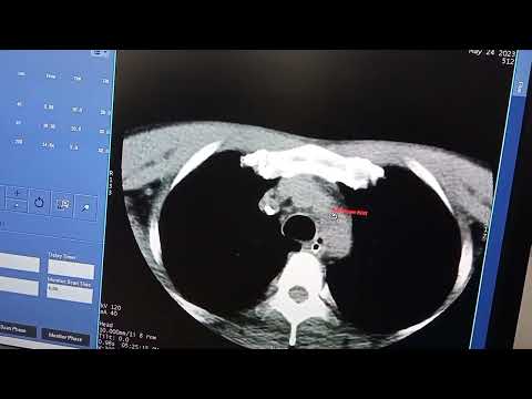 How to do ct brain neck angio