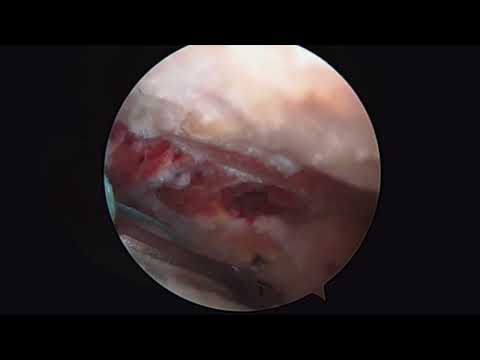 Full-Thickness Rotator Cuff Tear - Can it heal without surgery?
