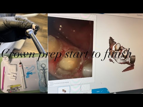 How to: crown prep from start to finish + How to make a temporary crown