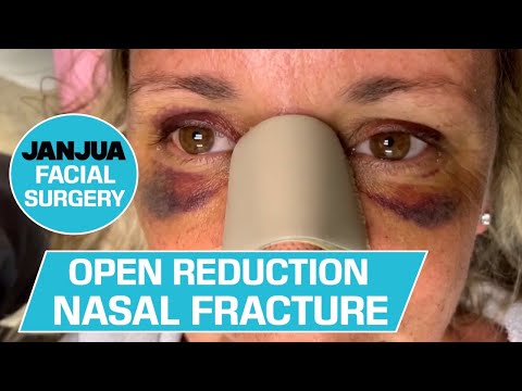 OPEN REDUCTION NASAL FRACTURE - DR. TANVEER JANJUA - NEW JERSEY
