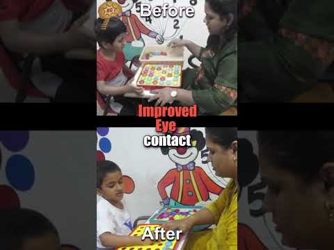 Regenerative Medicine Treatment for Improved Eye Contact in Autism