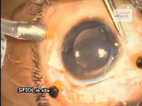Management of dislocated nucleus - Prof Dr S Natarajan
