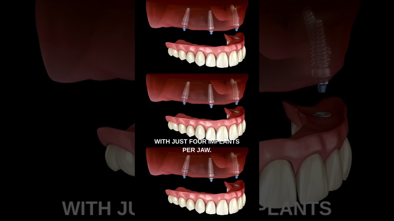 All-on-4 Dental Implants: Restore Your Smile, Confidence, and Quality of Life