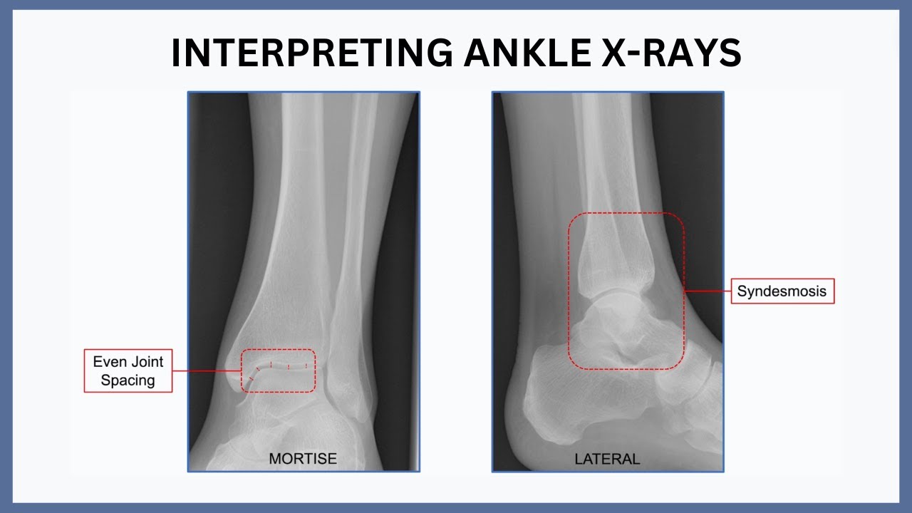 Interpreting Ankle X-Rays