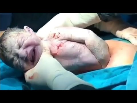 C-Section Delivery 👶🏽