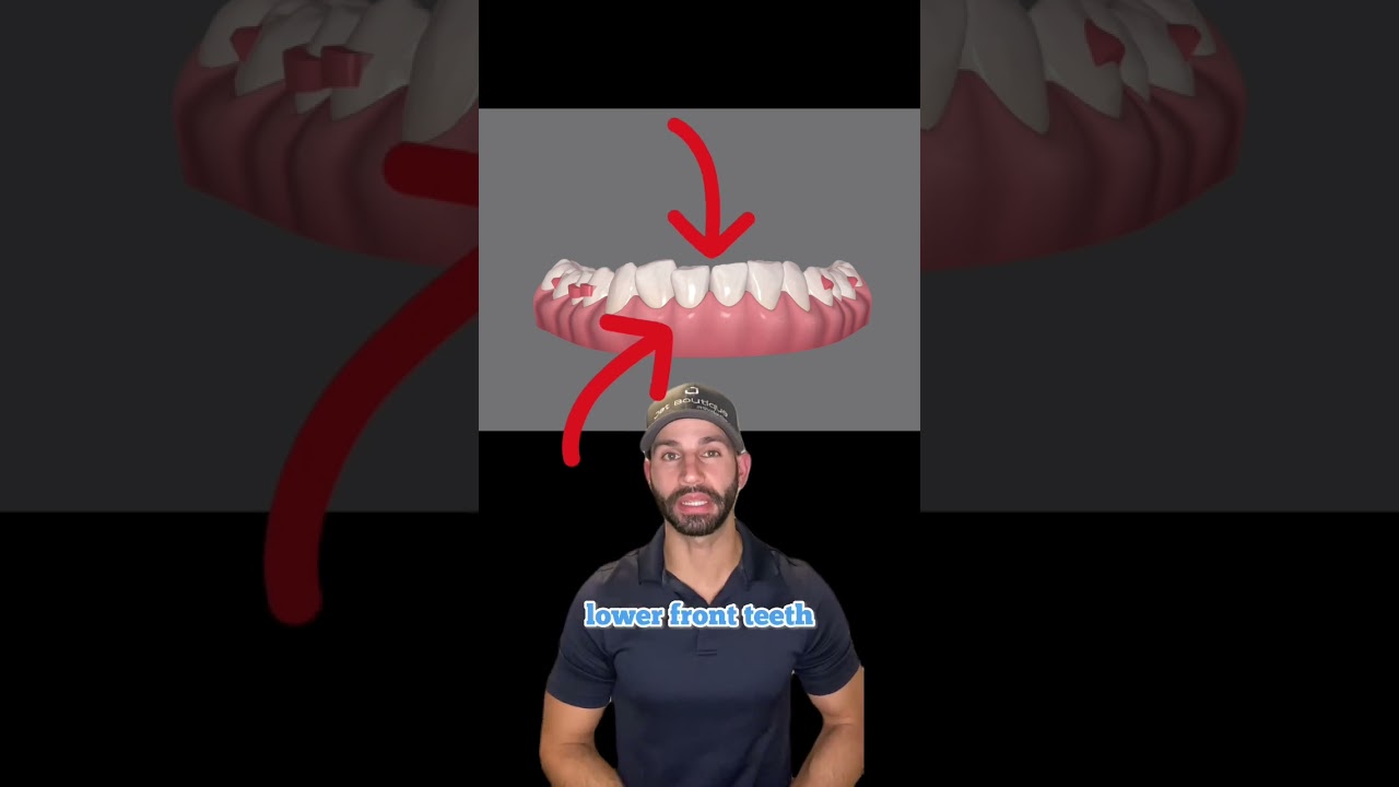 How I plan to fix this patient’s deep bite with Invisalign.