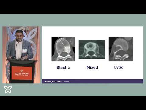Living with and treating bone metastasis