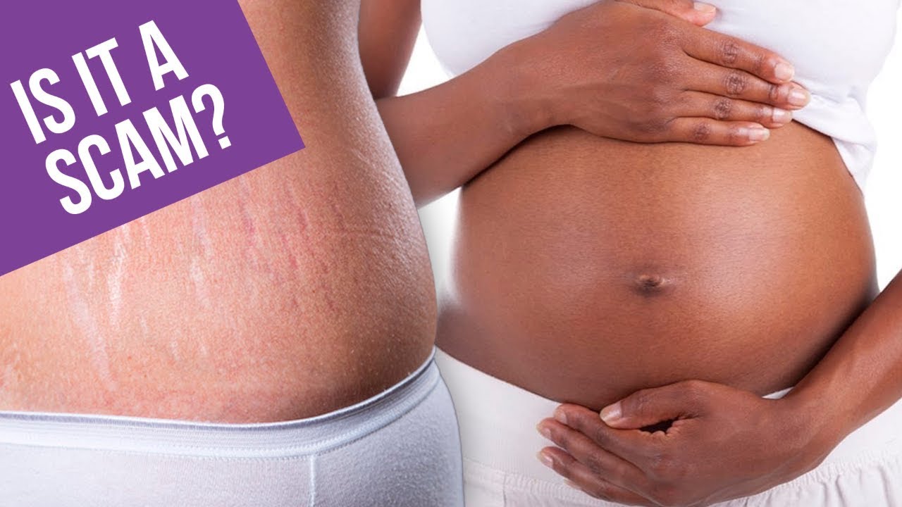 The TRUTH About Stretch Marks