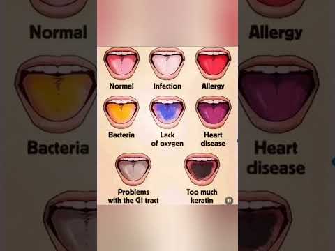 Different types of tongue colour according to health condition