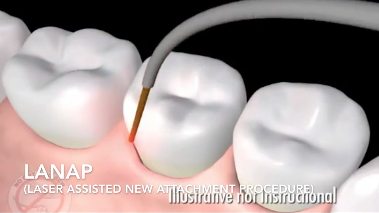 How Does Laser Surgery Work? Treat Gum Disease - LANAP