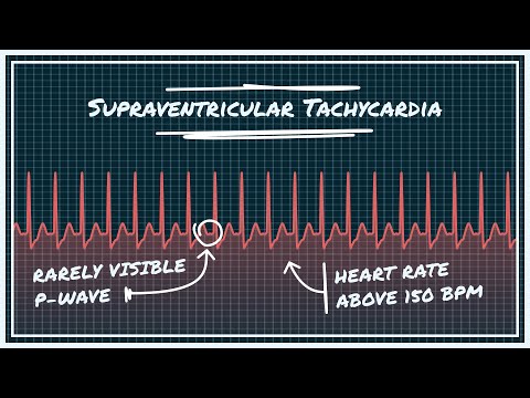 SVT - SUPRAVENTRICULAR TACHYCARDIA - Arrhythmias - Causes, symptoms, ECG - Stable & Unstable Patient