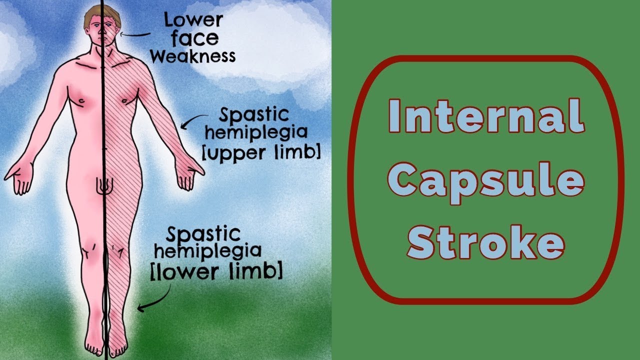 Internal Capsule Stroke