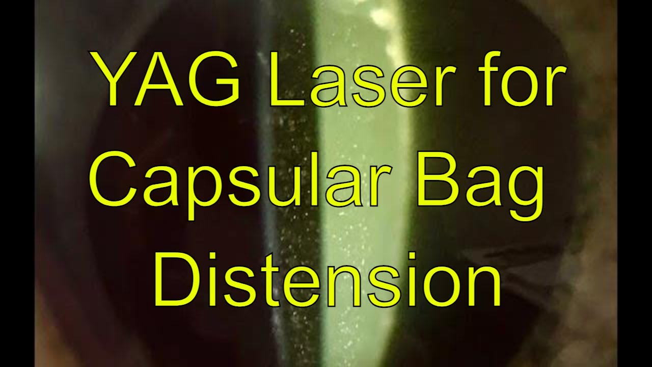 YAG Laser for Capsular Block / Capsular Bag Distension Syndrome (CBDS)  - Dr Simon Chen