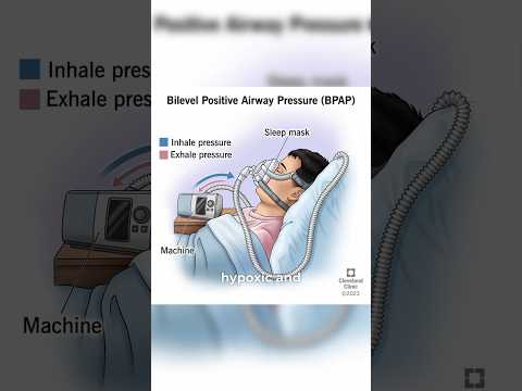 CPAP vs BiPAP.