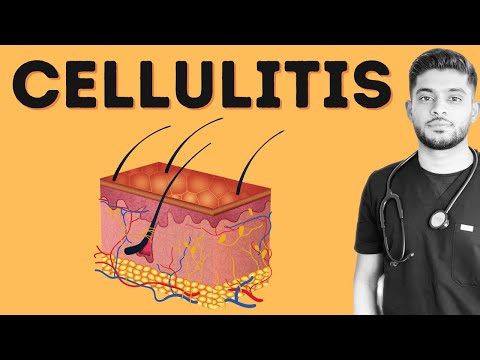Cellulitis | Definition, Causes, Prevalence, Risk Factors and Complications