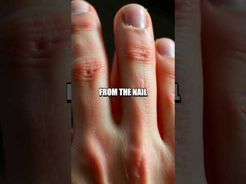 Early Signs of Psoriatic Arthritis