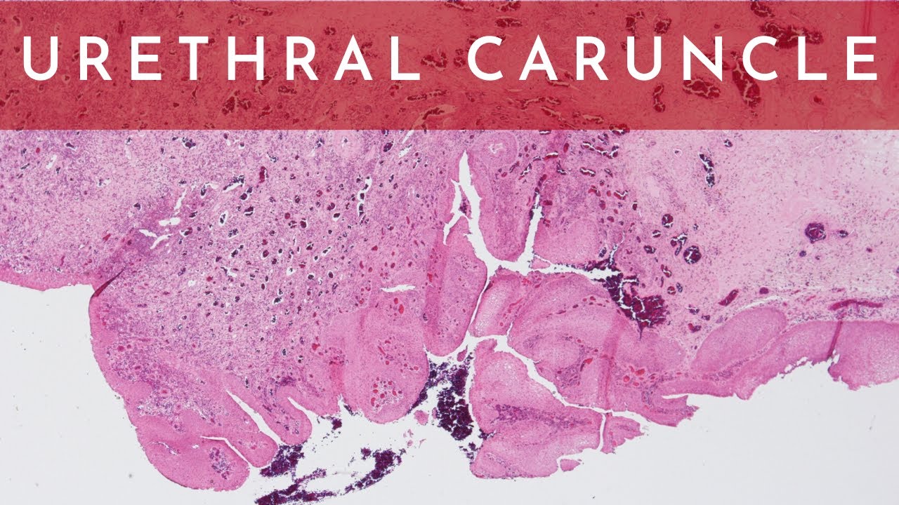 What is a Urethral Caruncle? - Pathology mini tutorial