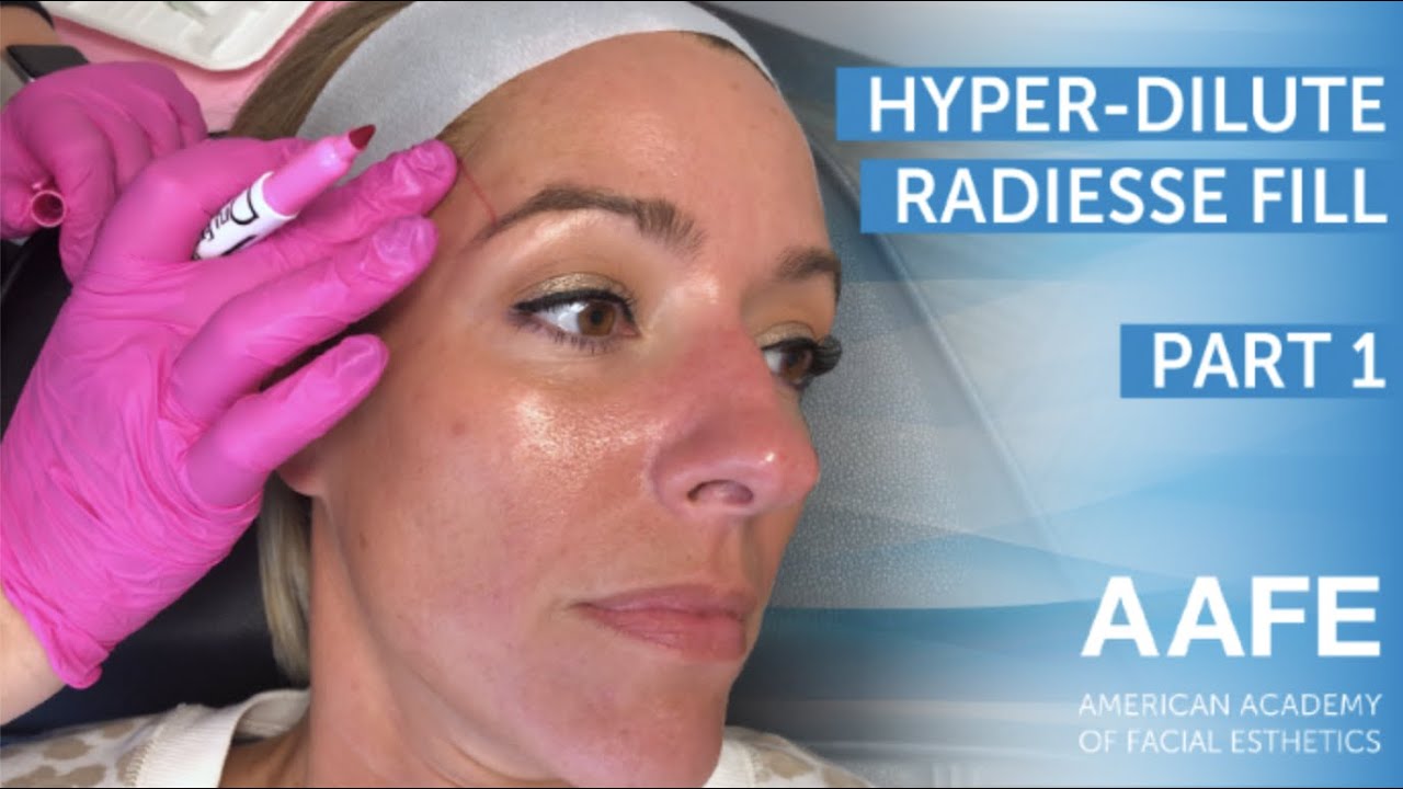 Hyperdilute/Dilute Radiesse Fill Pt.1