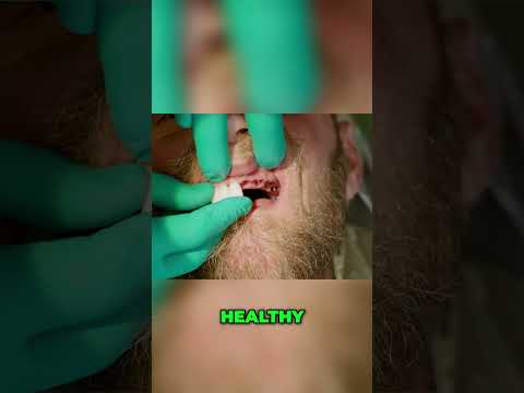 3 on 6 Dental Implants - Achieving Natural Looking Results with Real Gums
