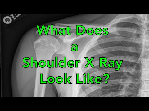 What Does a Shoulder X Ray Look Like?