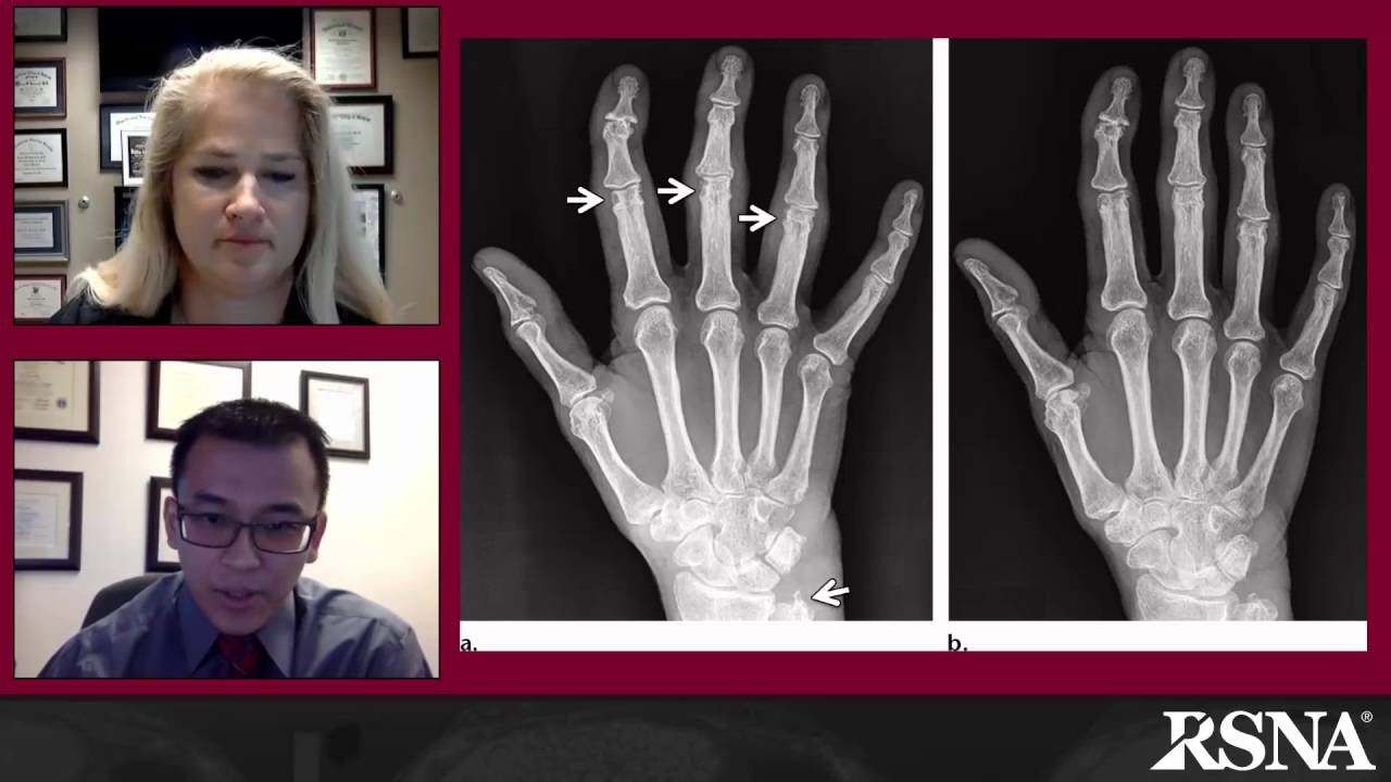 Adult Inflammatory Arthritides: What the Radiologist Should Know