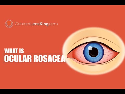 Ocular Rosacea | Symptoms, Causes, and Treatments
