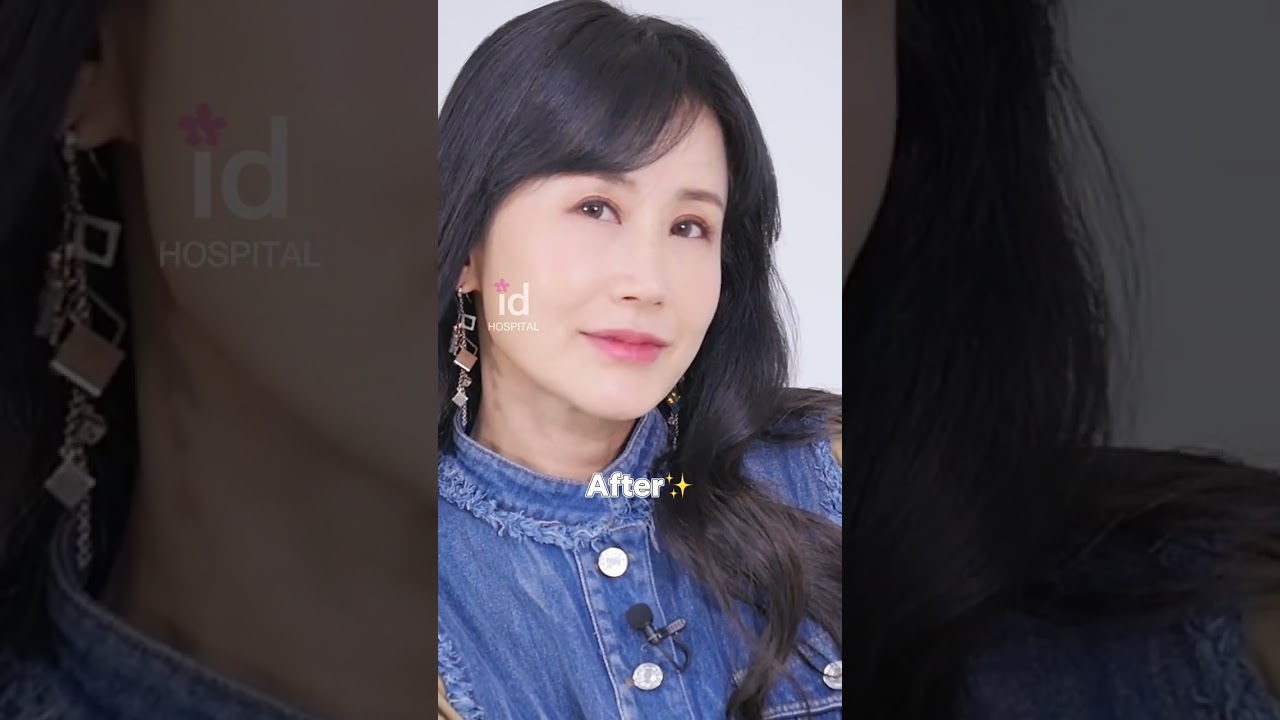 Mini Facelift Before and After #idhospital #shorts