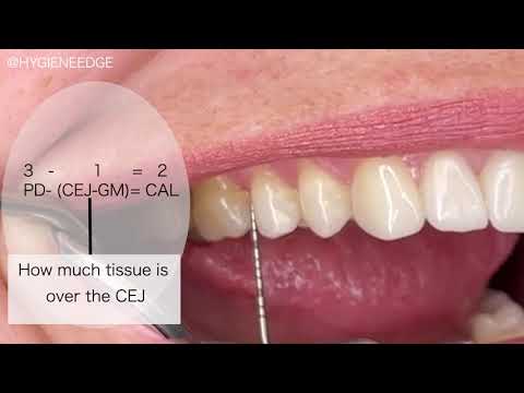 How to measure interproximal CAL for AAP
