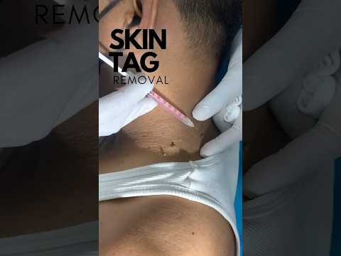 Skin Tag Removal Treatment | Say goodbye to Skin Tag at Skinaa Clinic #viral #shorts