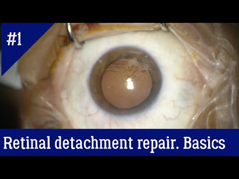 The general principles of vitrectomy for retinal detachment repair