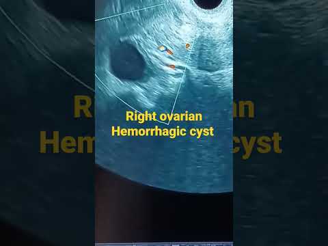 Ovarian cyst, Hemorrhagic cyst RO, lower abdominal pain, Ultrasound, endovaginal #shorts