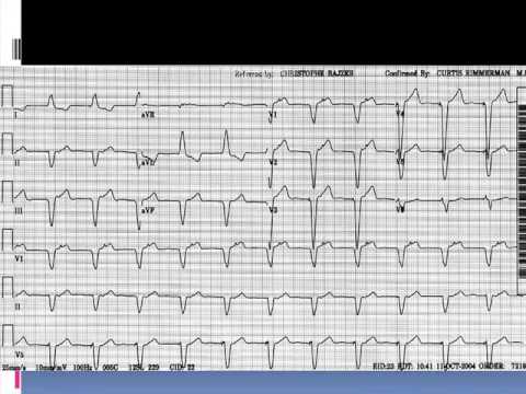 EKG Interpretation: Beyond the Basics