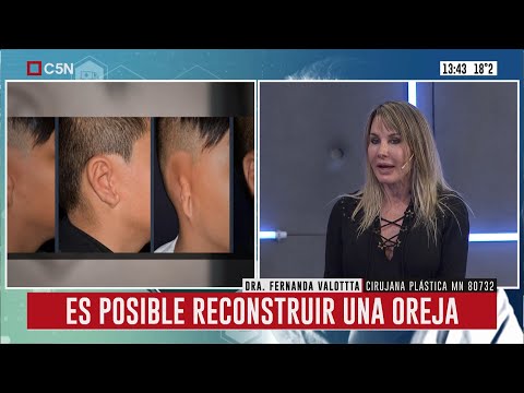 Microtia: Habla una cirujana plástica que realiza reconstrucciones de orejas