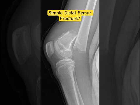 Not just distal femur fracture! #ortho #trauma #science #education