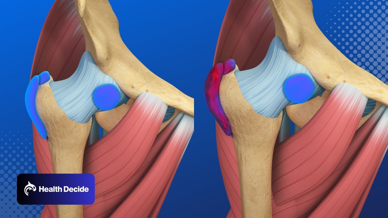 Hip Pain? Trochanteric (Hip) Bursitis - 3D Animation