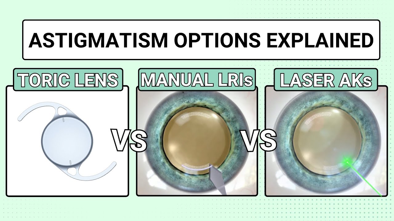 Cataract Surgery Astigmatism Treatment Options - MD Explains Toric Lenses and Other Options