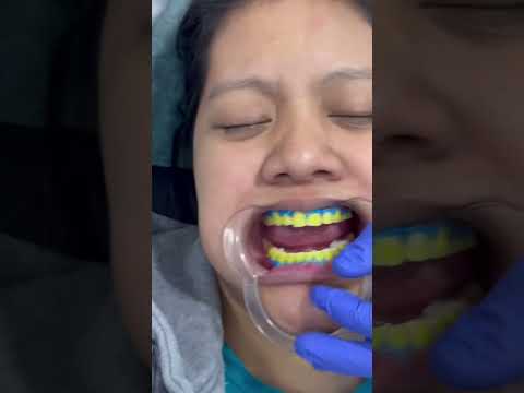 WhatsApp 03119581698 Teeth whitening #teethdecay #doctor #foreigntraineddentist #dentalclinic