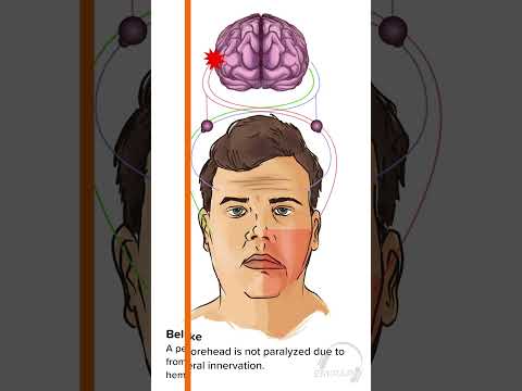Bell Palsy vs Stroke